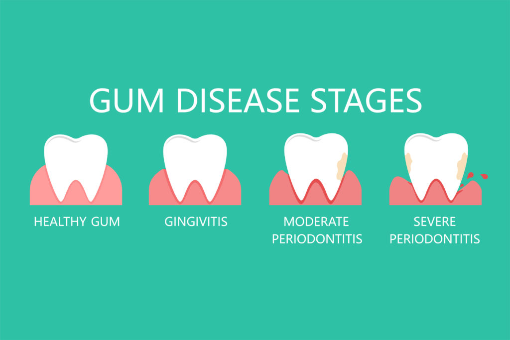 Gingivitis vs. Periodontitis — What’s the Difference?