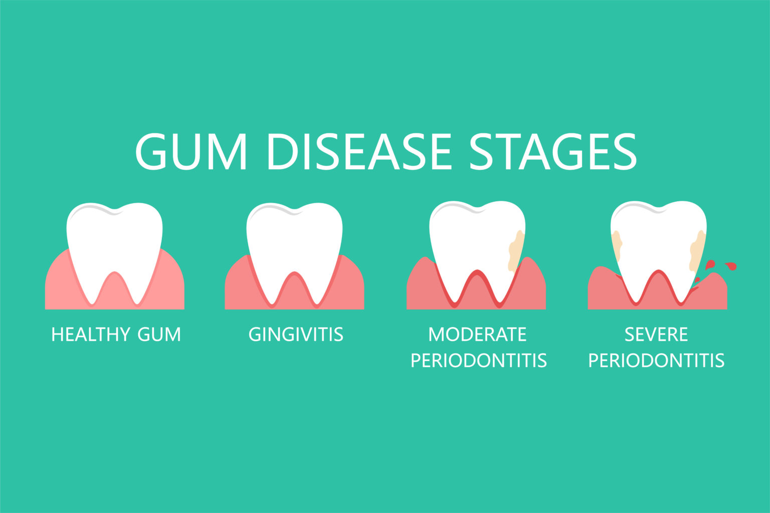 Gingivitis vs. Periodontitis — What’s the Difference?
